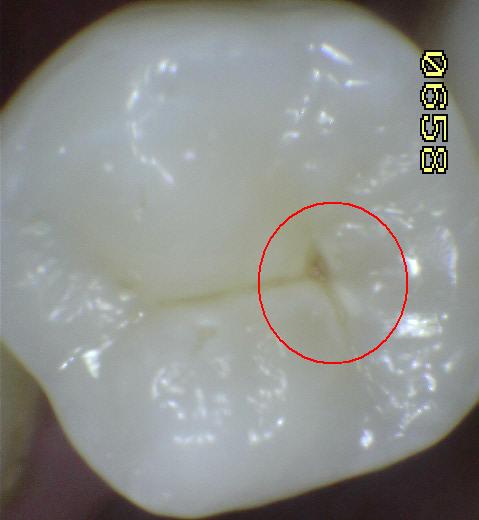 Caries Code In Pits And Fissure
